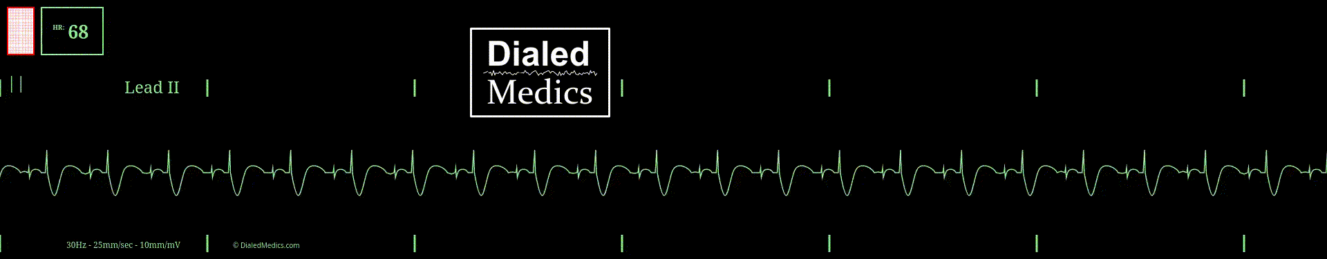 The Atrio-Ventricular Pacemaker EKG/ECG
