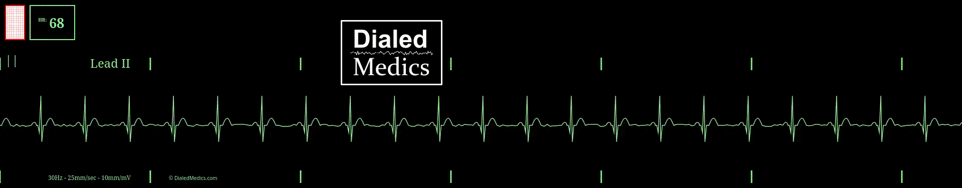 The Normal Sinus Rhythm (NSR) EKG/ECG