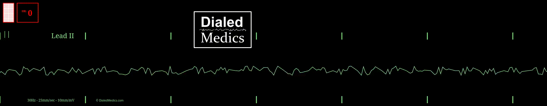 The Ventricular Fibrillation (VFib) EKG/ECG