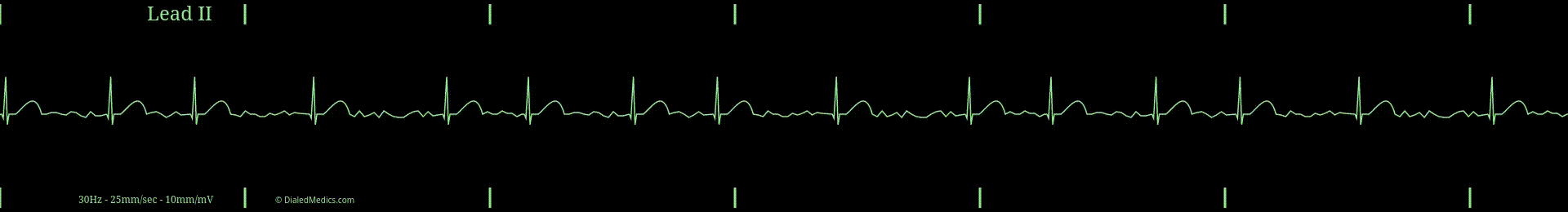 Rapid Atrial Fibrillation Ecg