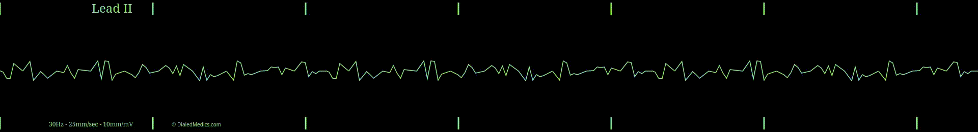 Ventricular Fibrillation Gif