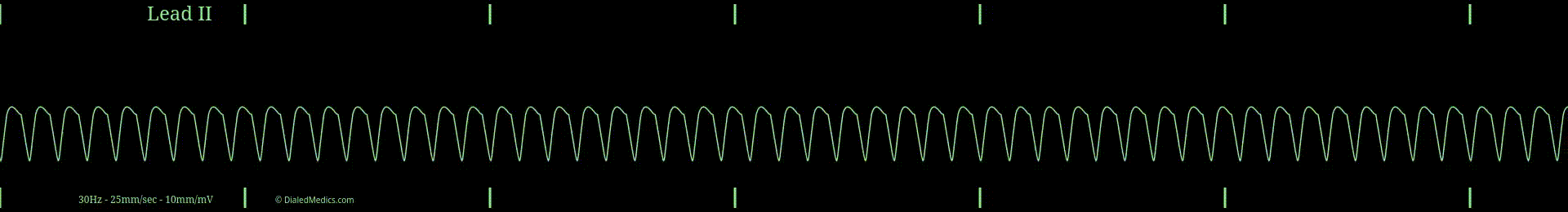 Ventricular Fibrillation Gif