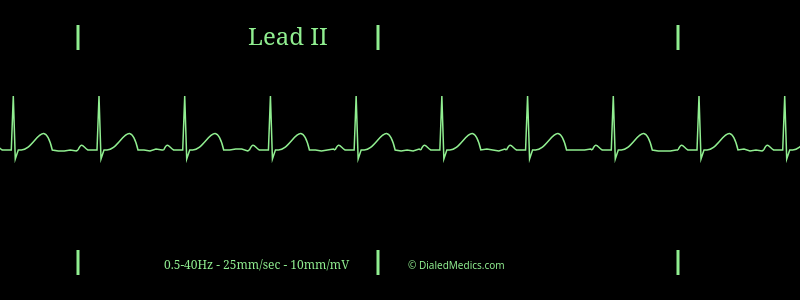 The Normal Sinus Rhythm (NSR) ECG/EKG
