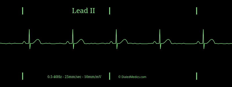 The Sinus Bradycardia ECG/EKG