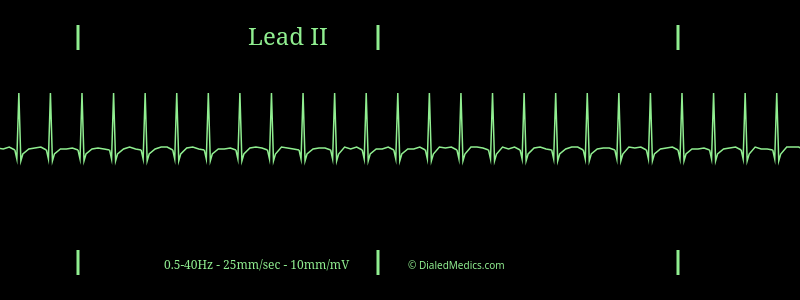 The Supraventricular Tachycardia (SVT) ECG/EKG