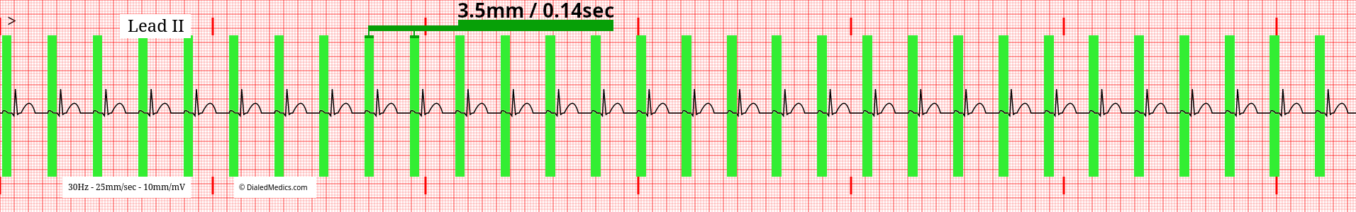 The Normal Sinus Rhythm (NSR) EKG/ECG