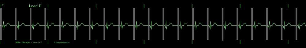 The Normal Sinus Rhythm (NSR) EKG/ECG