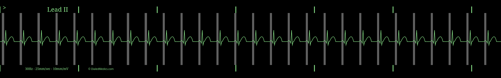 The Normal Sinus Rhythm (NSR) EKG/ECG