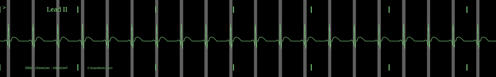 The Normal Sinus Rhythm (NSR) EKG/ECG
