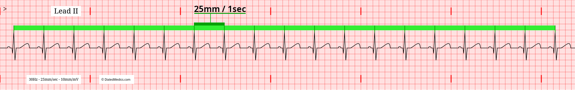 The Normal Sinus Rhythm (NSR) EKG/ECG