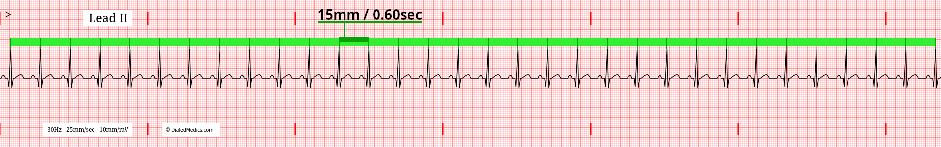 The Normal Sinus Rhythm (NSR) EKG/ECG
