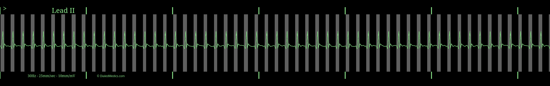 The Supraventricular Tachycardia (SVT) ECG/EKG
