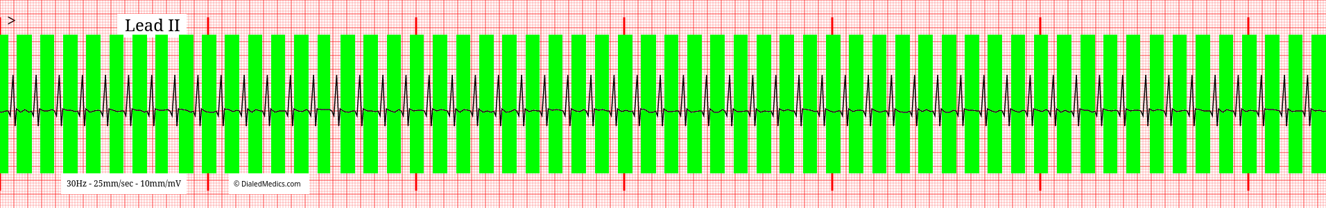 The Supraventricular Tachycardia (SVT) ECG/EKG