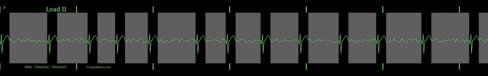 The Atrial Fibrillation (AF) ECG/EKG