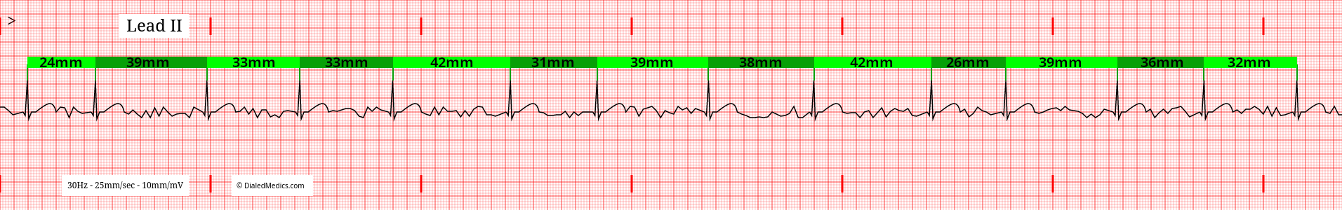 The Atrial Fibrillation (AF) ECG/EKG