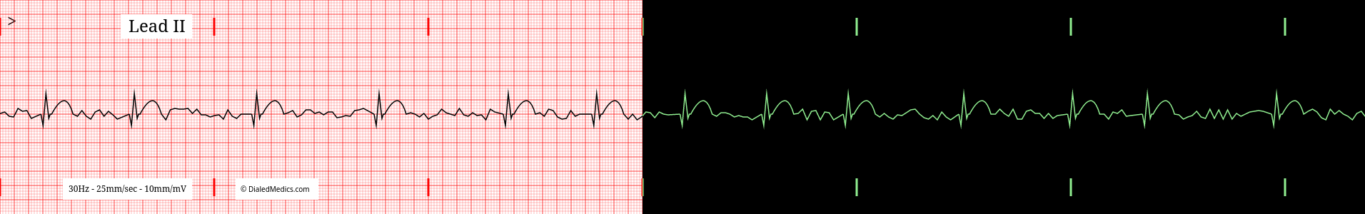 The Atrial Fibrillation (AF) ECG/EKG