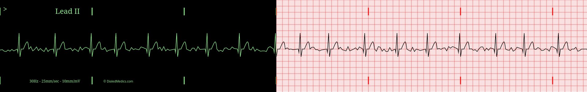 The Atrial Fibrillation (AF) ECG/EKG