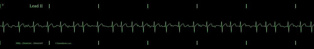 The Atrial Fibrillation (AF) ECG/EKG