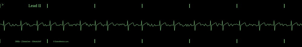The Atrial Fibrillation (AF) ECG/EKG