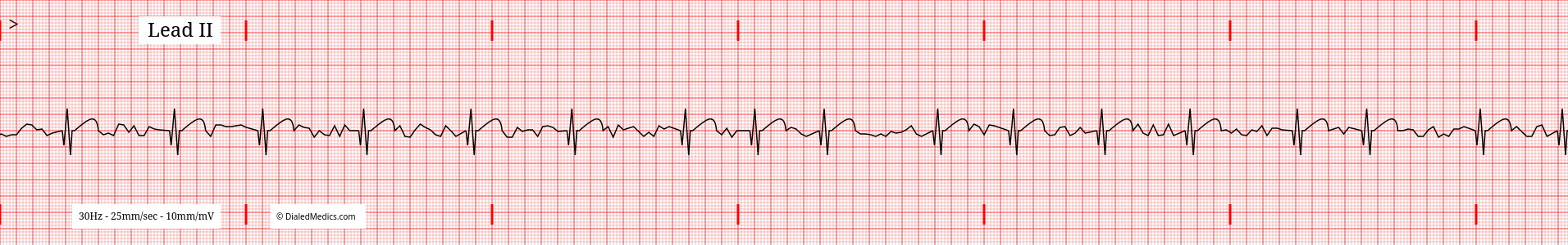 The Atrial Fibrillation (AF) ECG/EKG