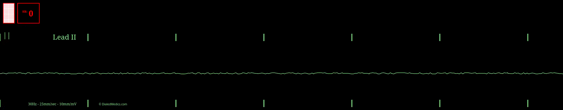 The Asystolic EKG/ECG