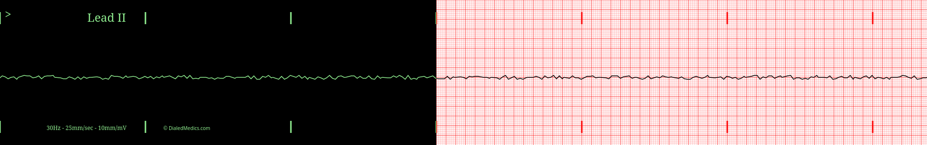 The Asystole ECG/EKG