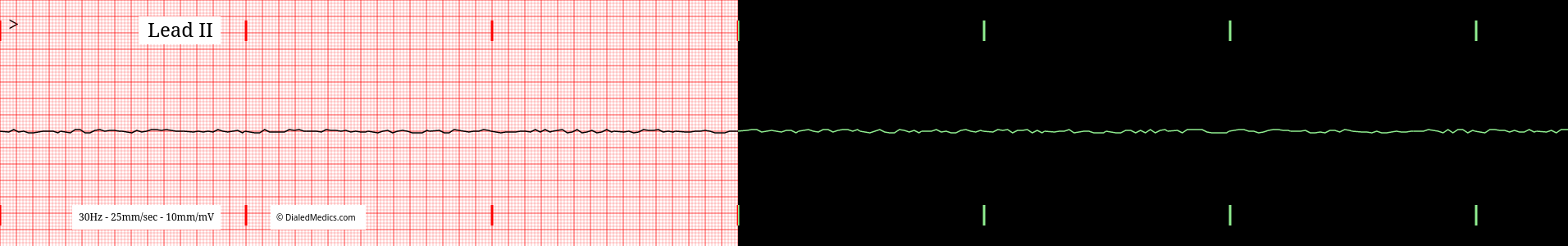 The Asystole ECG/EKG