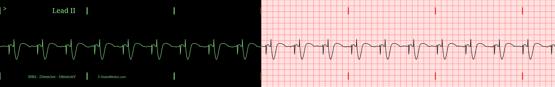 The Atrio-Ventricular Pacemaker EKG/ECG