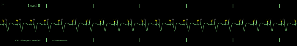 The Atrio-Ventricular Pacemaker EKG/ECG
