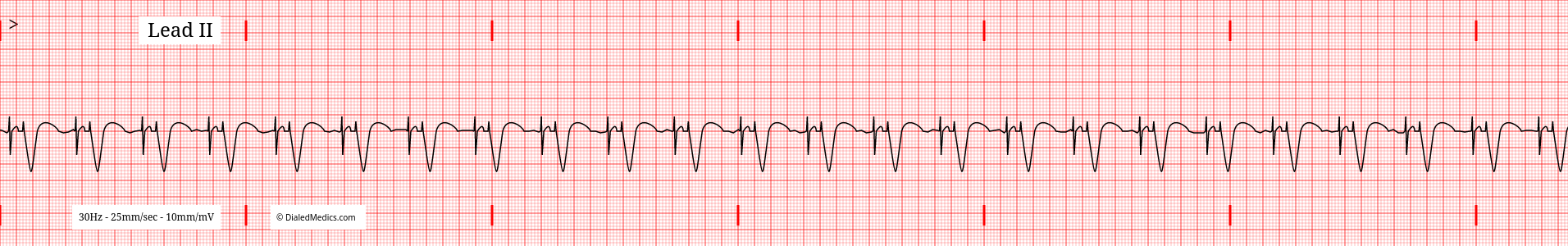 The Atrio-Ventricular Pacemaker EKG/ECG