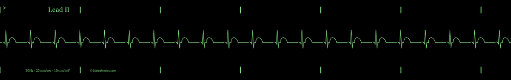 The Normal Sinus Rhythm (NSR) EKG/ECG