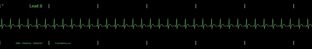 The Sinus Tachycardia EKG/ECG