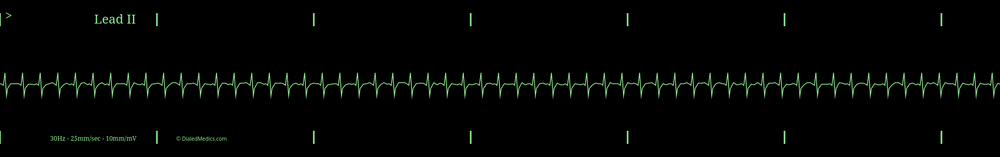 The Supraventricular Tachycardia (SVT) EKG/ECG