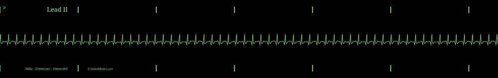 The Supraventricular Tachycardia (SVT) ECG/EKG