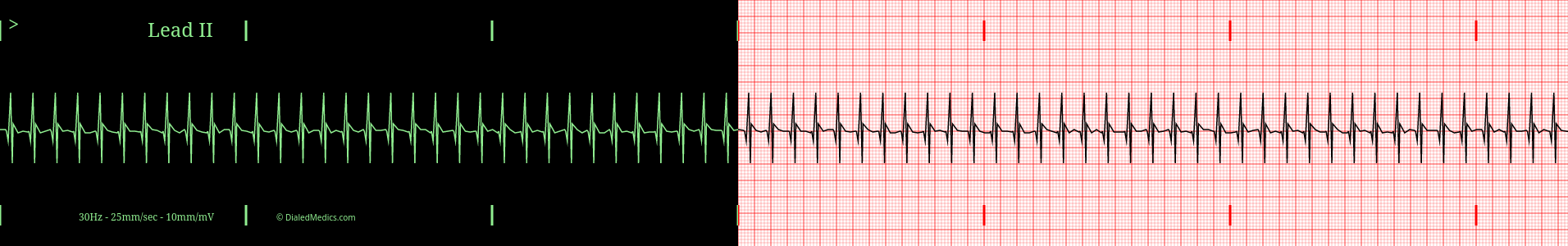 The Supraventricular Tachycardia (SVT) ECG/EKG