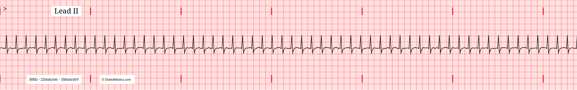 The Supraventricular Tachycardia (SVT) ECG/EKG