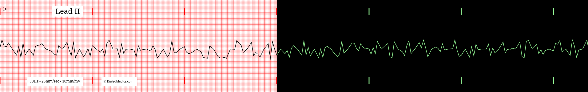 The Ventricular Fibrillation (VF) ECG/EKG