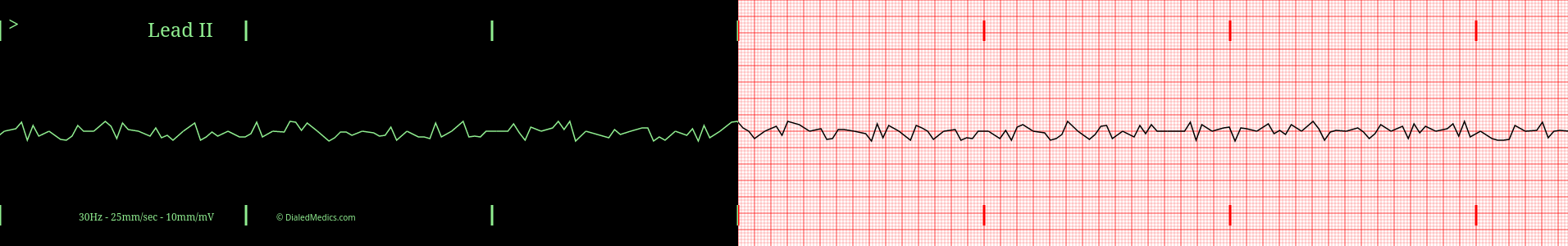 The Ventricular Fibrillation (VF) ECG/EKG
