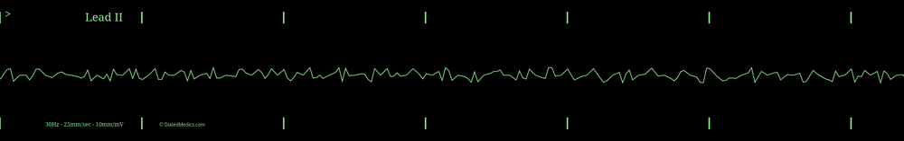 The Ventricular Fibrillation (VF) ECG/EKG