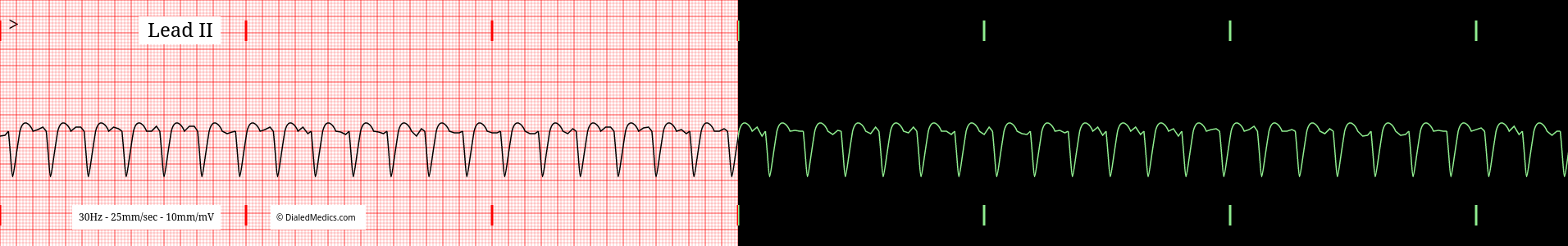 The Ventricular Tachycardia ECG/EKG