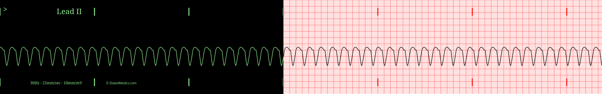 The Ventricular Tachycardia ECG/EKG