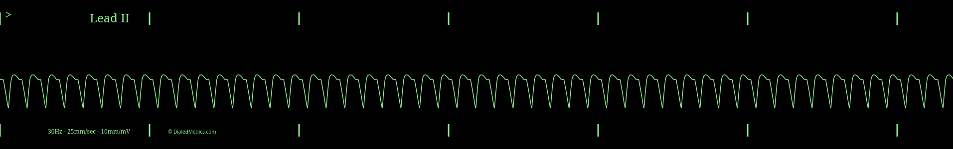 The Ventricular Tachycardia ECG/EKG