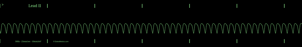 The Ventricular Tachycardia ECG/EKG