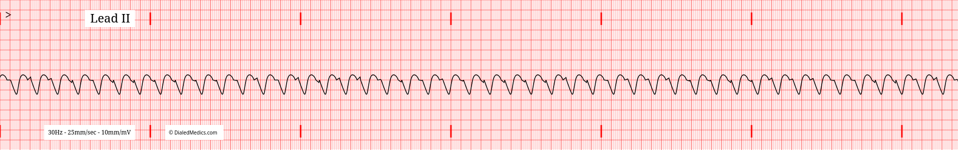 The Ventricular Tachycardia ECG/EKG