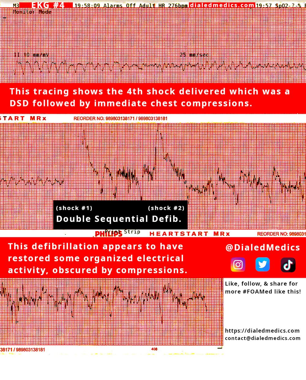 An Unsuccessful Resuscitation of COVID ARDS by an ALS team.