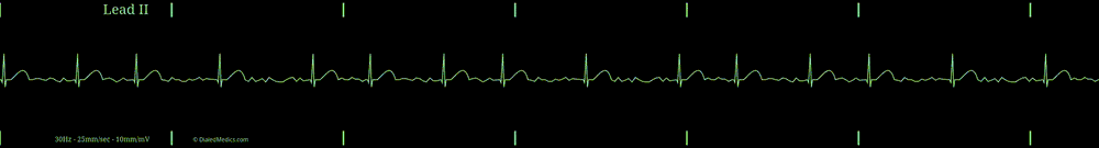 Free EKG Library - Software Generated EKG's