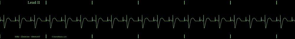 The Atrio-Ventricular Pacemaker EKG/ECG