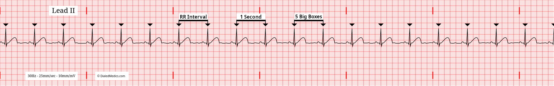 The Normal Sinus Rhythm (NSR) ECG/EKG