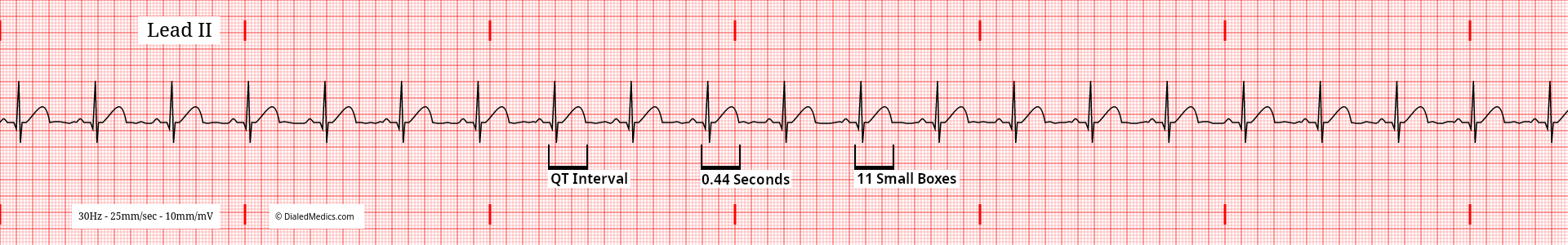 The Normal Sinus Rhythm (NSR) ECG/EKG