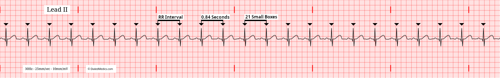 The Normal Sinus Rhythm (NSR) ECG/EKG